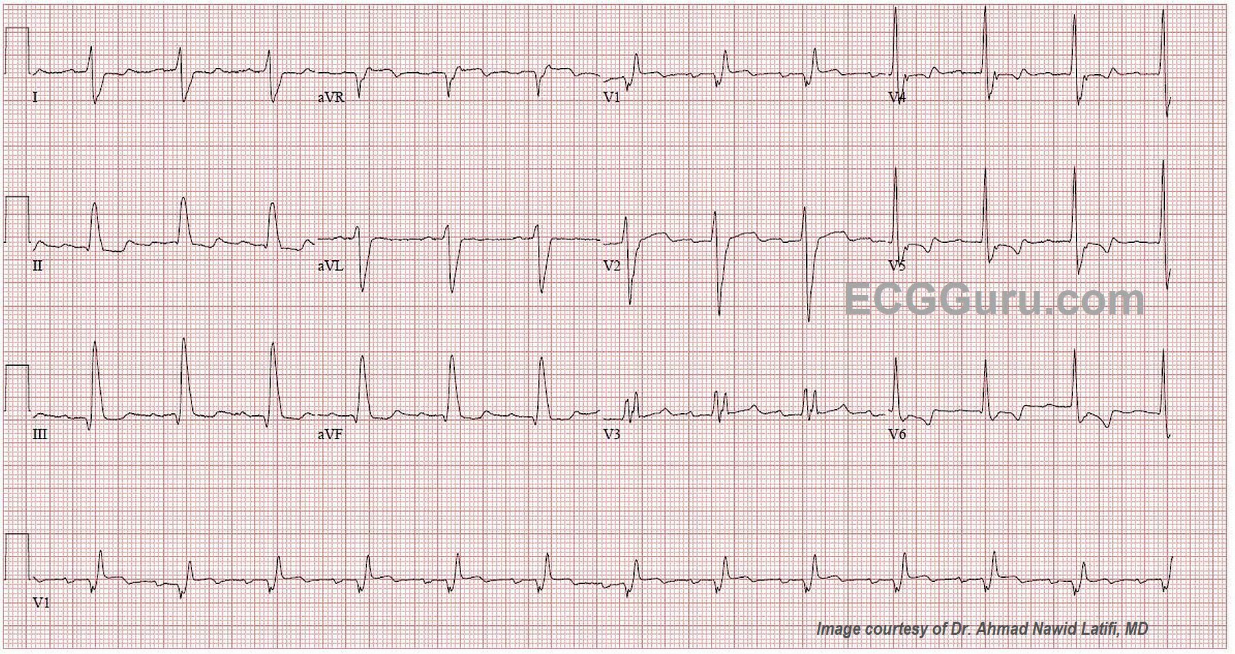 Bifascicular Block With First Degree Avb Ecg Guru Instructor Resources